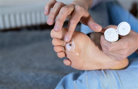 Effective Plantar Wart Removal At The Foot Practice