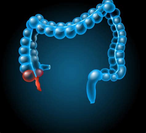 Appendix Surgery Dr Brian Harkins