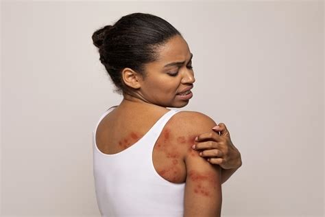 Amebiasis Cutánea ¿qué Es Doctores México