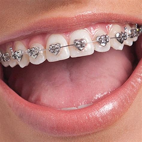 Pin By Kahlia Meehan On Braces 😬 Perfect Teeth Teeth Braces Perfect