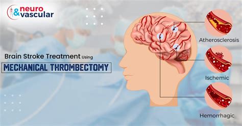 Brain Aneurysm Treatment With Intrasaccular Web And Contour Devices