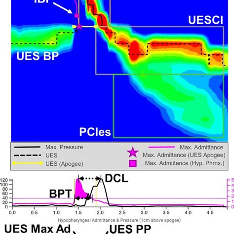 A Pressure Topography Tracing Of A Swallow From Hypopharynx To Proximal