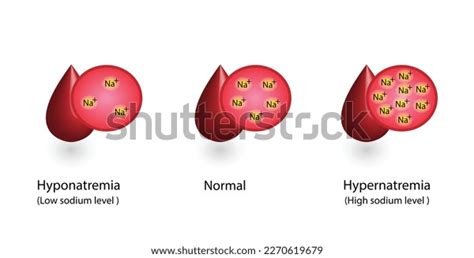 Hypernatremia High Plasma Sodium Level Hyponatremia Stock Vector Royalty Free 2270619679