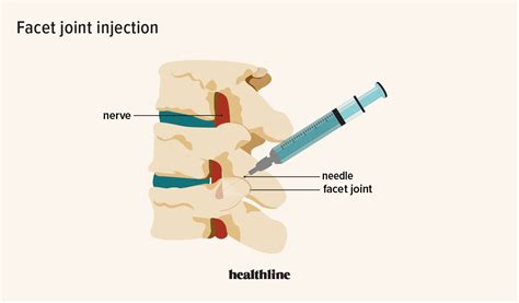 Facet Joint Injection Facet Joint Injection Dove Archives Delaware