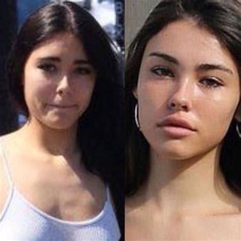 Madison Beer Plastic Surgery In 2024 Plastic Surgery Facial
