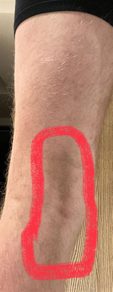 12 Months Post Op Hamstring Graft And Meniscus Repair Anyone Experience Still Having Slight