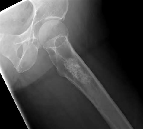 Chondrosarcoma The Bone School