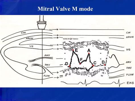 Echocardiographic Evaluation Of Mitral Valve Disease Pptx