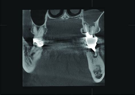 Cone Beam Computed Tomography In Endodontics Morita