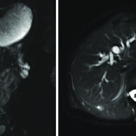 Magnetic Resonance Cholangiography Showing Dilatation Of The Download Scientific Diagram