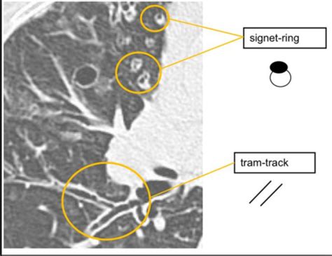 Bronchiectasis And Cystic Fibrosis Flashcards Quizlet