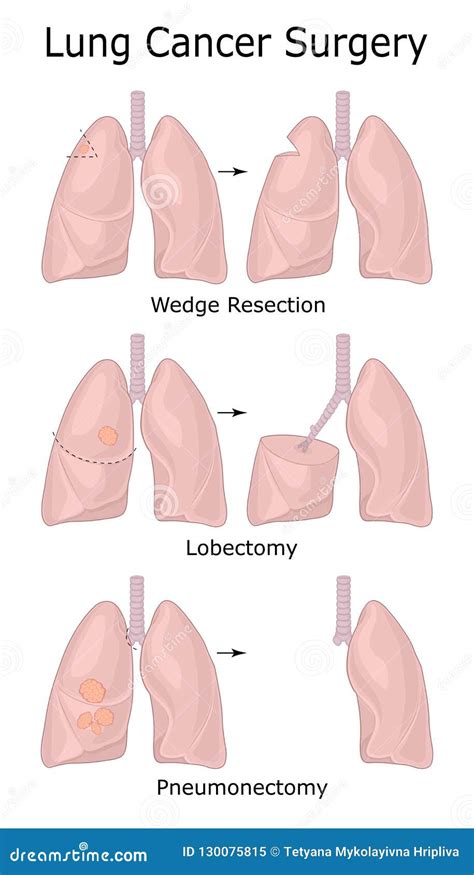 Lobectomy Cartoons Illustrations And Vector Stock Images 15 Pictures