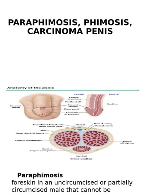 Paraphimosis Phimosis And Penile Cancer Pdf Medical Specialties