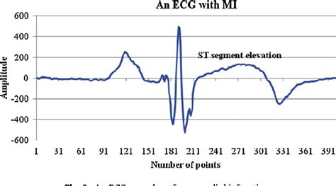 Figure 2 From Myocardial Infarction Classification With Multi Lead Ecg Using Hidden Markov