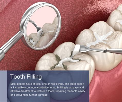 Tooth Filling Nyc Best Dental Fillings In Midtown Manhattan And Downtown Brooklyn