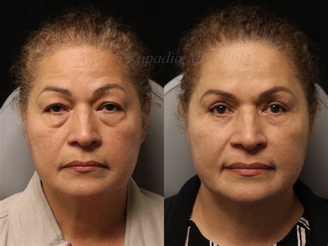 Before And 8 Months After Upper And Lower Blepharoplasty Surgery With