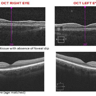 Macular OCT Comparing Both Eyes With Age Matched Normal Download Scientific Diagram