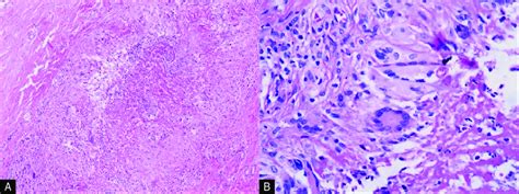 A Granulomatous Reaction With Histiocytes And Giant Cells Suppurative Download Scientific