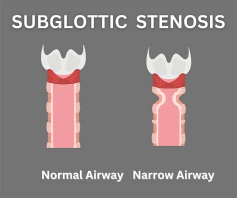 Subglottis Tracheostomy Tube In Situ With Subglottic Suction Ports And