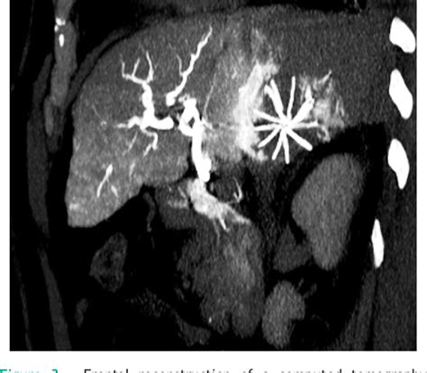 Figure 3 From Treatment Of Hepatocellular Carcinomas By Thermal Ablation And Hepatic