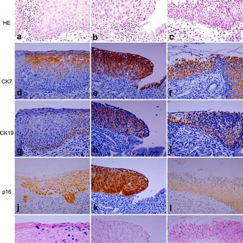 Disease Progression To Sil Cin1 Cin2 And Cin3 Endpoints In The Nis Download Table