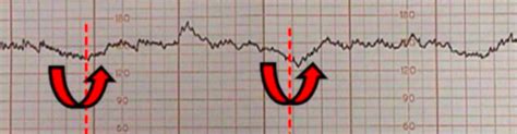Early Decels Vs Late Decels Vs Variable Decels Covers Umbillical Cord Prolapse Flashcards Early Decels Vs Late Decels Vs Variable Decels Covers Umbillical Cord Prolapse Flashcards