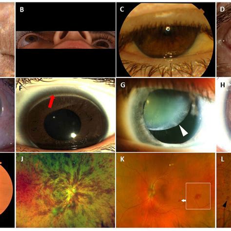 Stages Of Hypertensive Eye Disease The Scheie Classification Was Used Download Scientific Stages Of Hypertensive Eye Disease The Scheie Classification Was Used Download Scientific