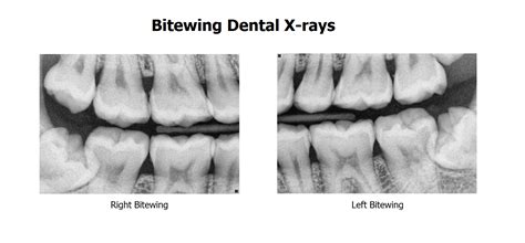 Bitewing Dental X Rays News Dentagama