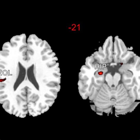Statistical Parametric Mapping Regions Superimposed On A Download