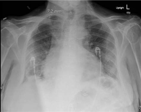 Reexpansion Pulmonary Edema Cxr 2 Jetem 2017 Jetem