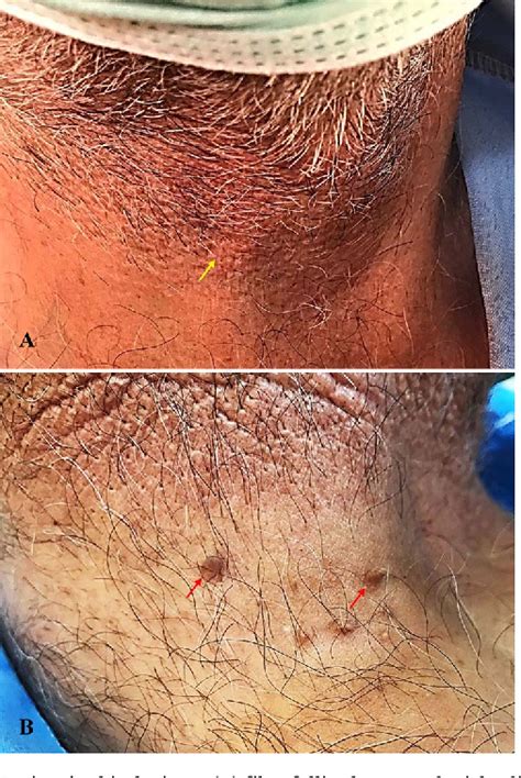 Figure 1 From A Case Of Recurrent Pneumothorax And Skin Lesions
