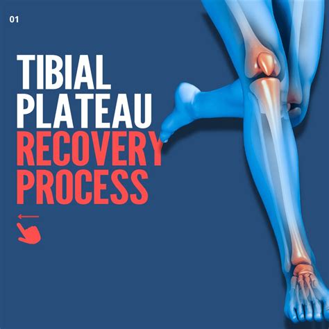Physiotherapy After Tibia Plateau Fracture Fixation OFF