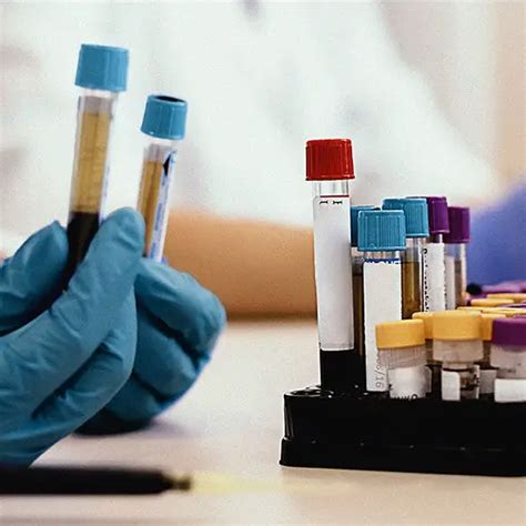 Book Platelet Distribution Test Price In Delhi India Ganesh Diagnostic
