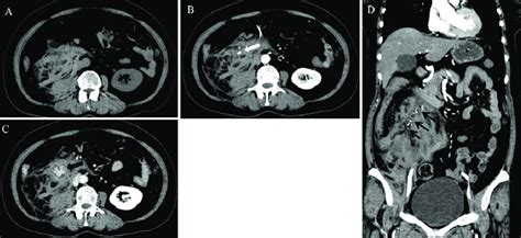 A Abdominal Plain Ct On Admission Shows Massive Intra Abdominal