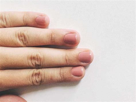 Nail Psoriasis Vs Fungus Learn The Signs Artofit