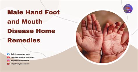 Male Hand Foot And Mouth Disease Home Remedies