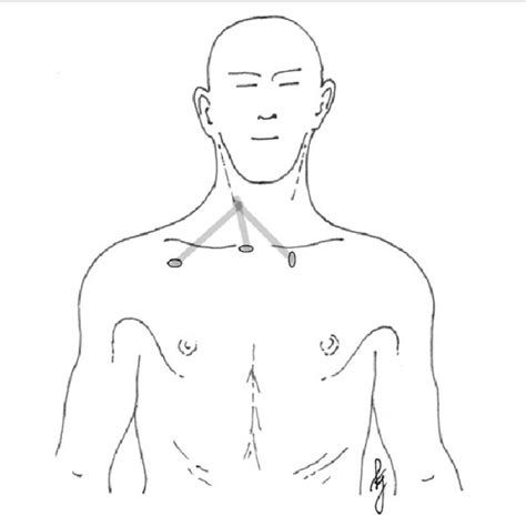 Pdf From Four Parathyroid Gland Exploration To A Minimally Invasive Technique Minimally