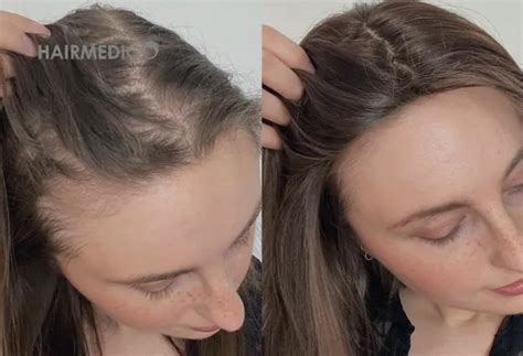 500 Hair Grafts Before And After 2025 Hairmedico Dr Arslan