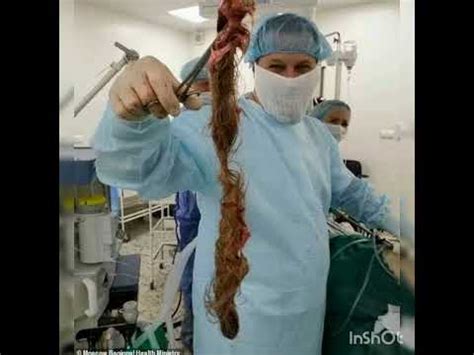 Removal Of Ovarian Dermoid Cystfilled With Pus Mucouslot Of Hairs