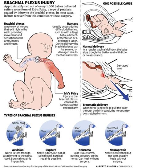 Brachial Plexus Injuries Pediatric Physical Therapy Pediatric Therapy Pediatric Nursing
