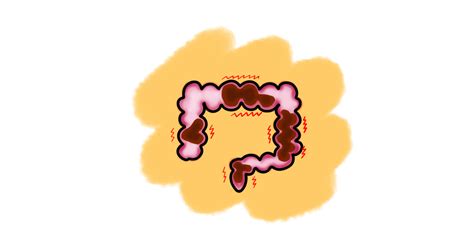 Functional Constipation Vs Slow Transit Constipation