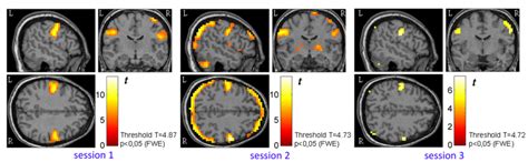 patient s female 28 y o activation in primary sensorimotor cortex