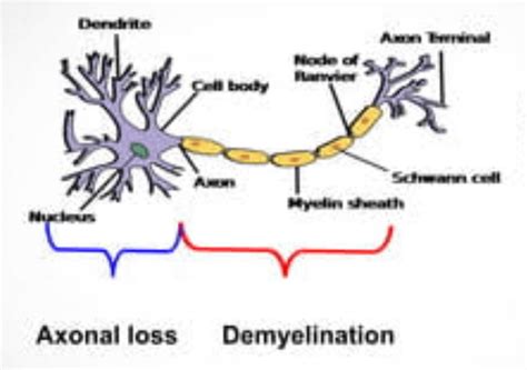 What Is Exactly Difference Between Axonal Vs Demyelinating Neuropathy R Neurology
