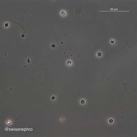 Dysmorphic Erythrocytes In A Kidney Transplant Patient IgA Nephropathy With Hematuria Phase