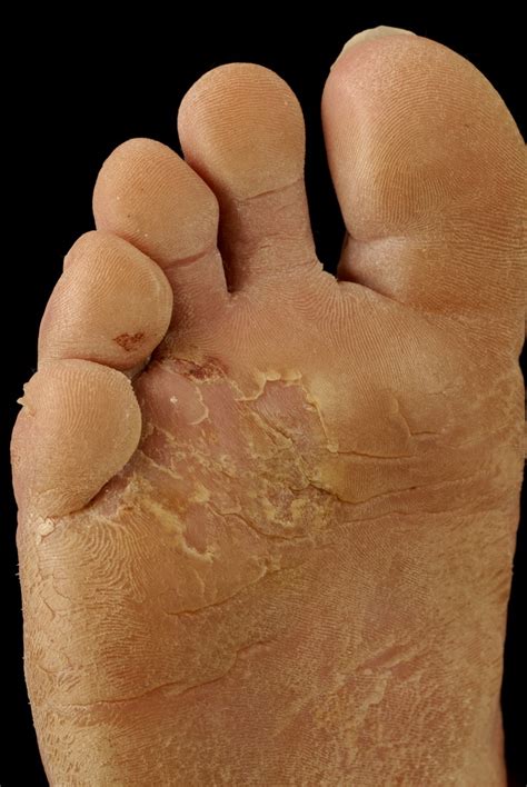 Epidermolytic Palmoplantar Keratoderma Palmoplantar Keratoderma And