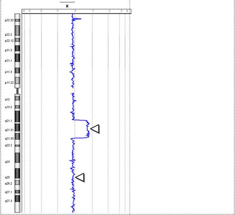 X Chromosome Microarray Result On Patient 3 The Primary Result From