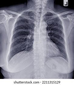 Xray Photo Older Womens Breasts According Stock Photo 2211315129 Shutterstock