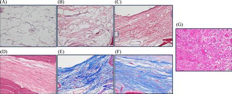 Classification Of Bone Marrow Fibrosis Silver Impregnation Staining Of