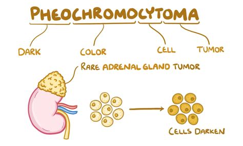 Pheochromocytoma Flashcards Memorang