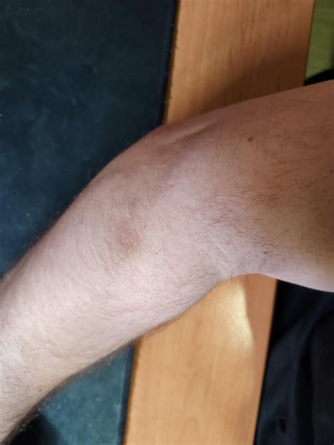 Bruising At Injection Site Near Forearm R Bpc 157